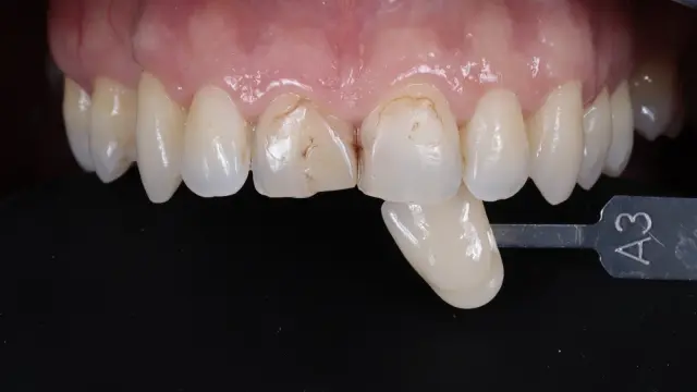 Achieving perfect symmetry: restoring central incisors