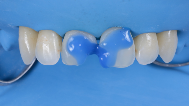 Achieving perfect symmetry: restoring central incisors