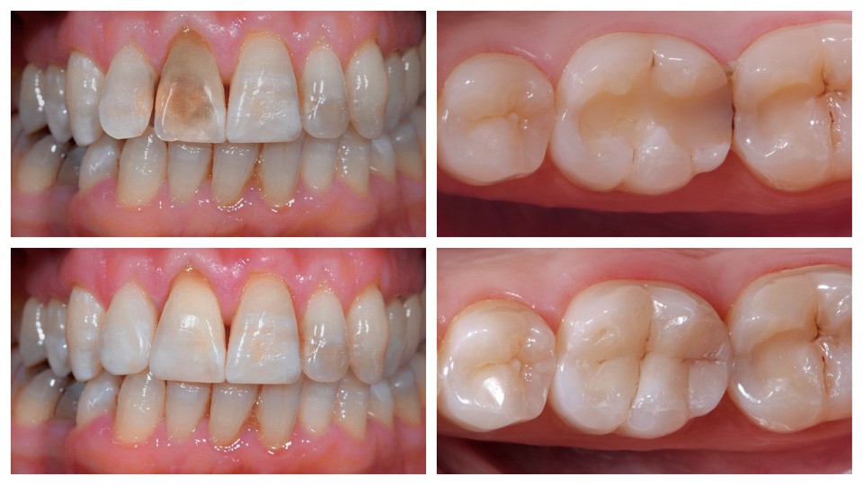 Venus Diamond® Shade Guide