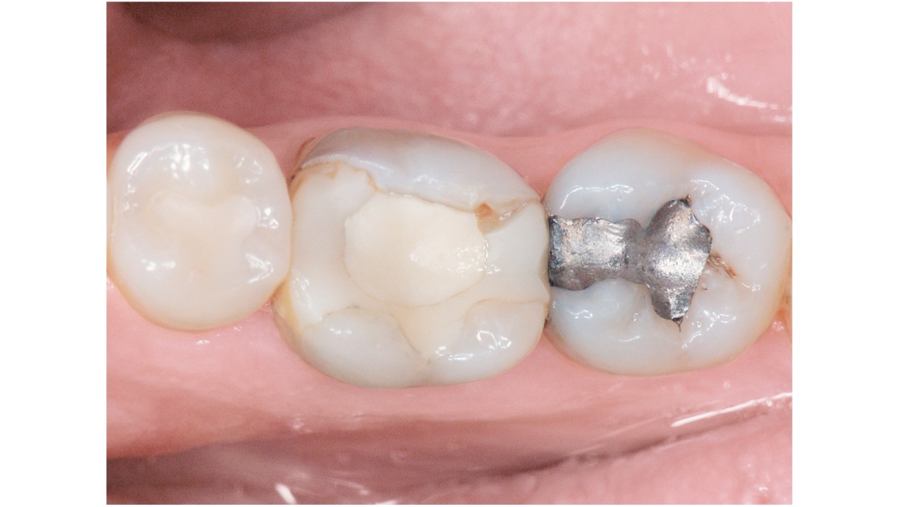 Venus® Flow Syringe Assortment