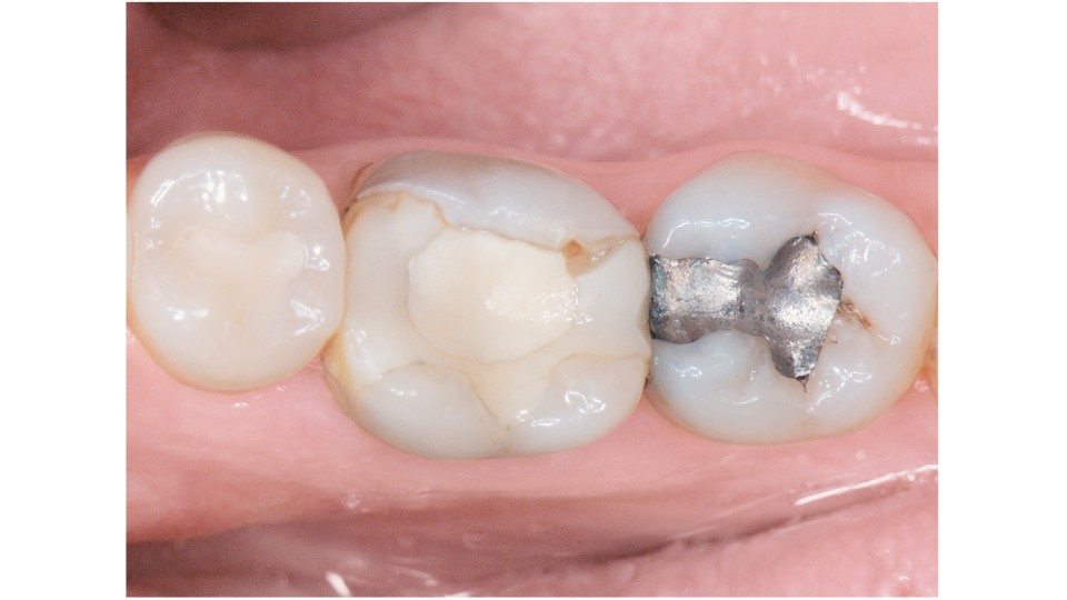 Venus® Flow Syringe Assortment