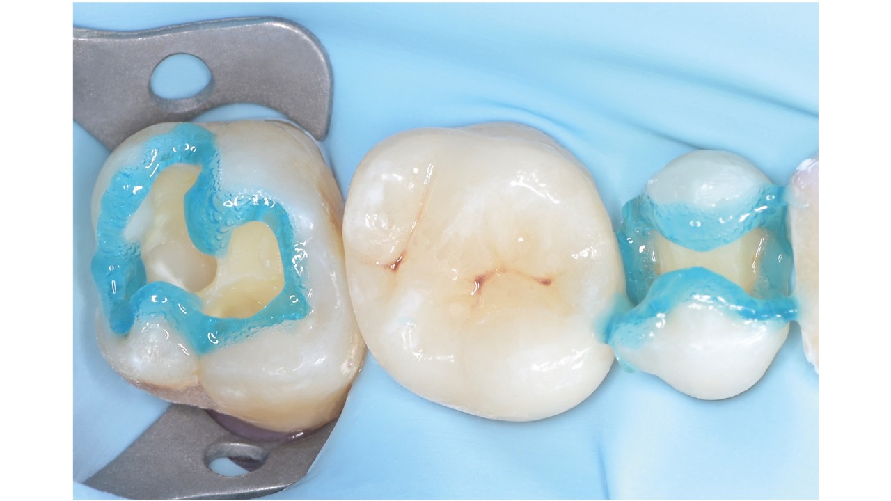 Venus® Pearl Shade Guide