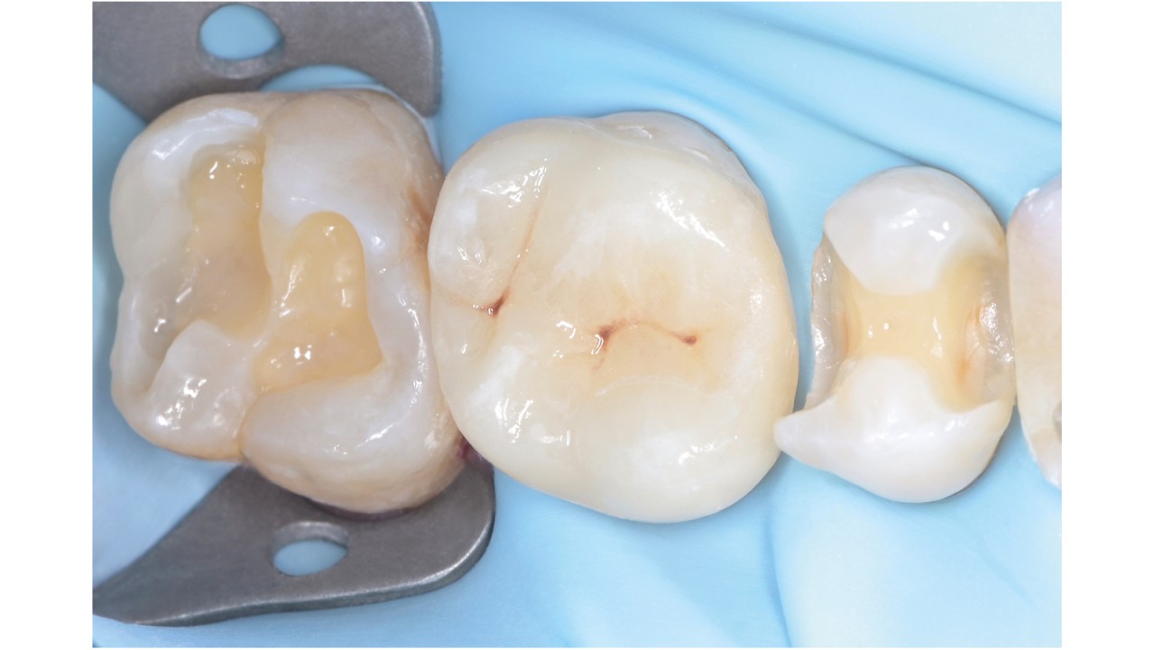 Venus® Pearl Shade Guide