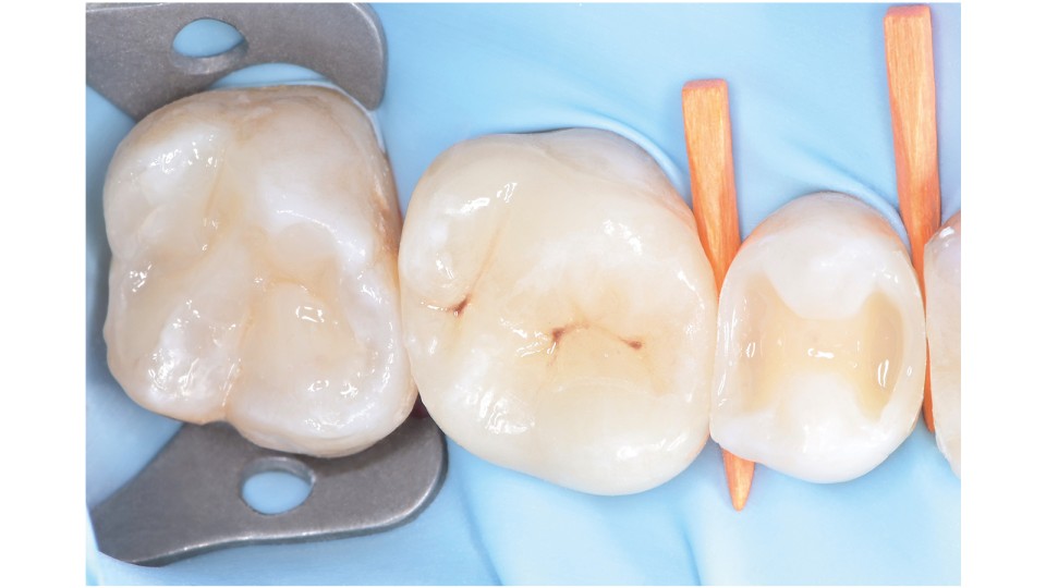 Venus® Pearl Shade Guide