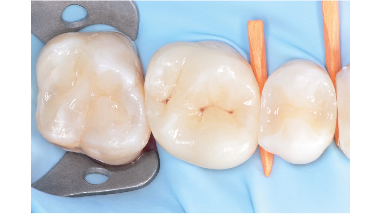 Venus® Pearl Shade Guide