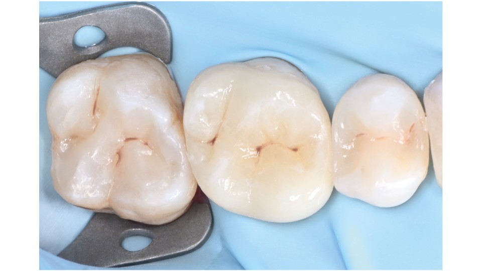 Venus® Pearl Shade Guide