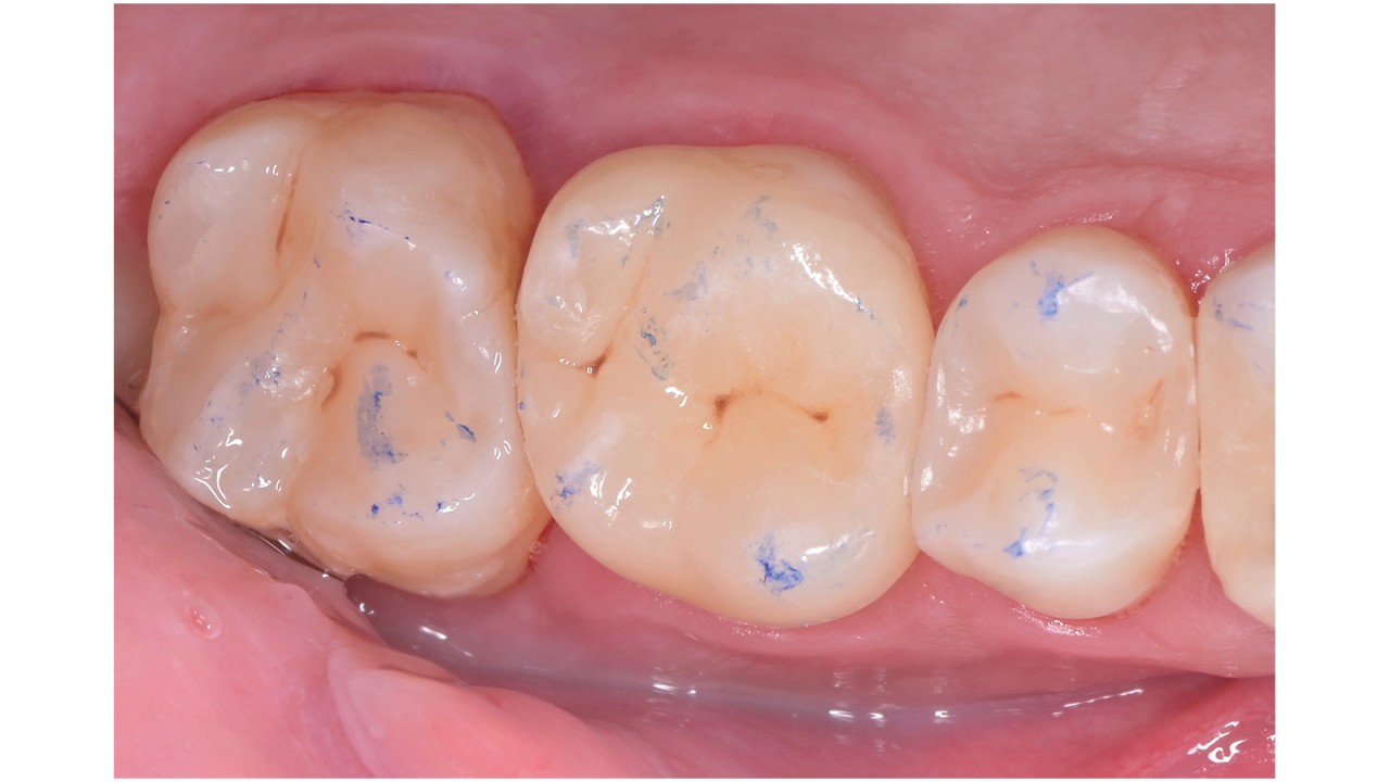 Venus® Pearl Shade Guide