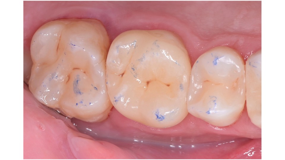 Venus® Pearl Shade Guide