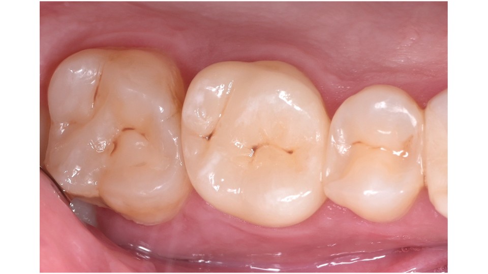 Venus® Pearl Shade Guide