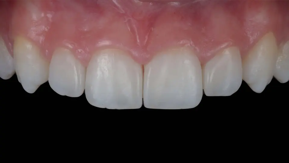 Venus® Pearl PURE