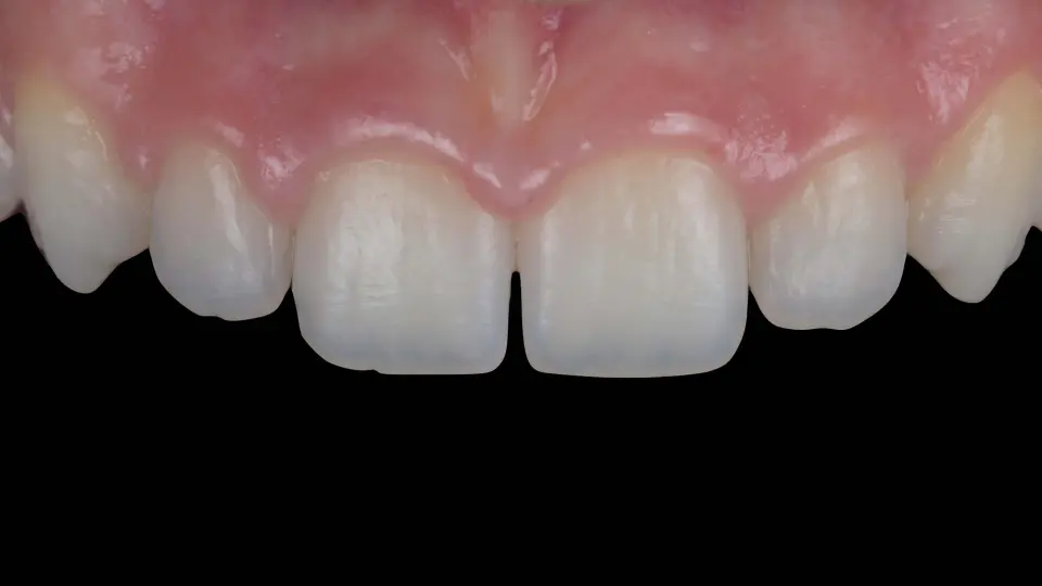 Venus® Pearl PURE
